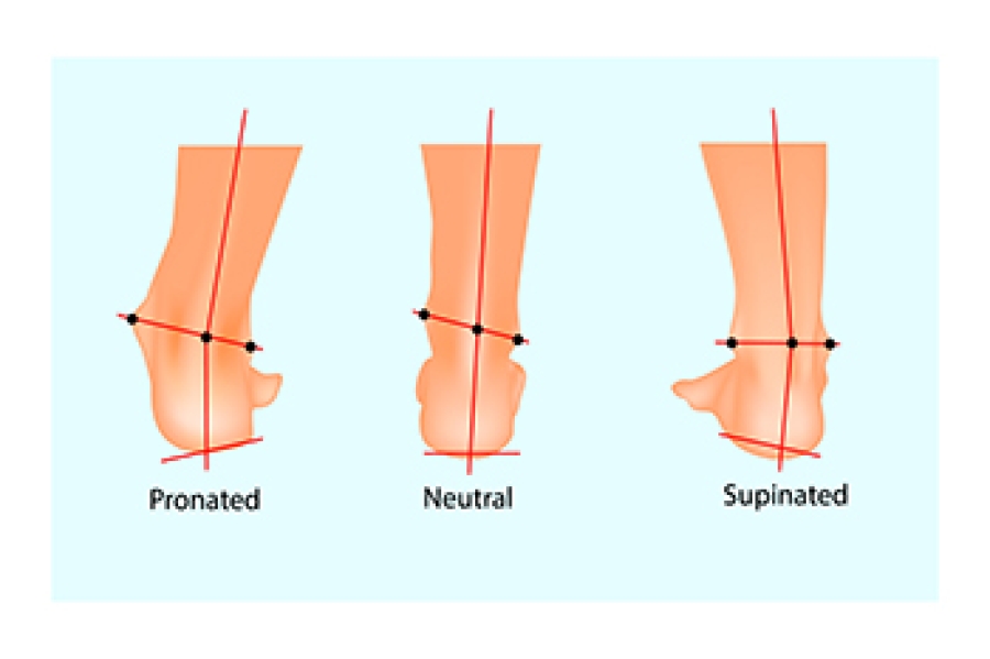 Signs and Causes of Overpronation